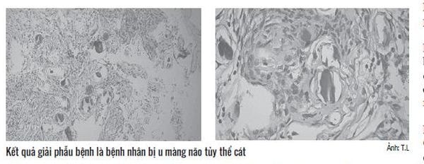Điều trị thành công bệnh nhân u màng tủy
